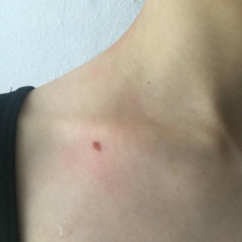 Ergebnisse Vorher/Nachher - LeaLea - Natürliche Creme zur Warzen ...