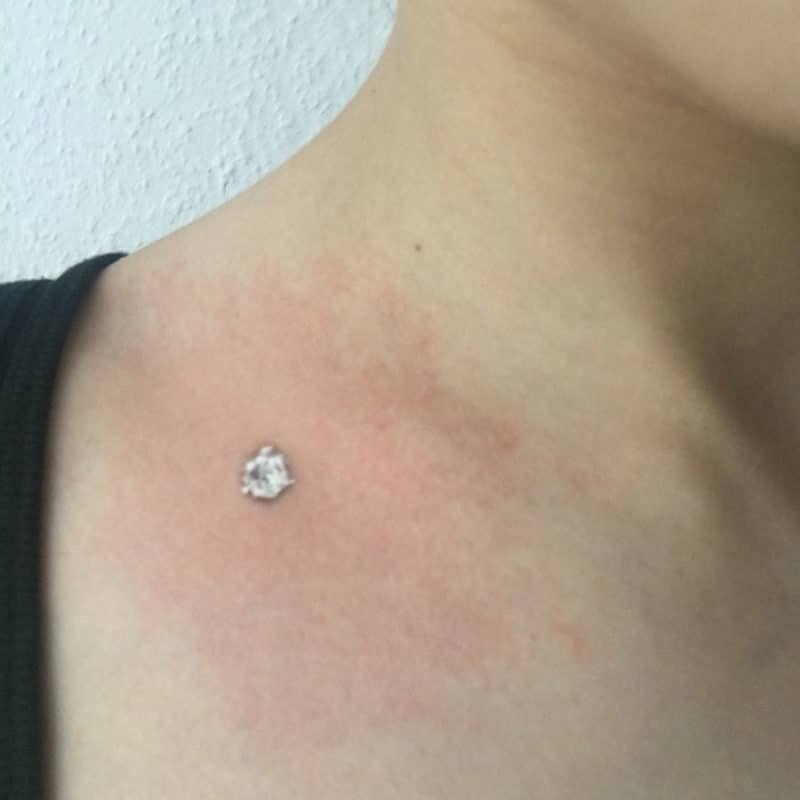 Ergebnisse Vorher/Nachher - LeaLea - Natürliche Creme zur Warzen ...