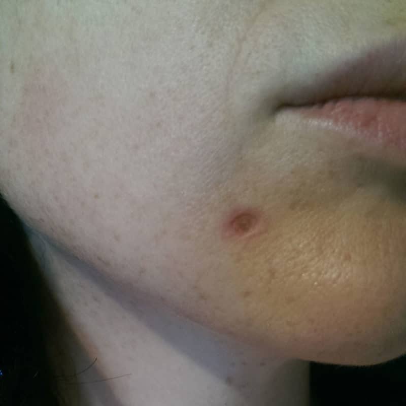 Ergebnisse Vorher/Nachher - LeaLea - Natürliche Creme zur Warzen ...