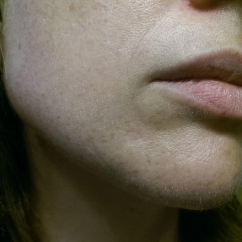 Ergebnisse Vorher/Nachher - LeaLea - Natürliche Creme zur Warzen ...