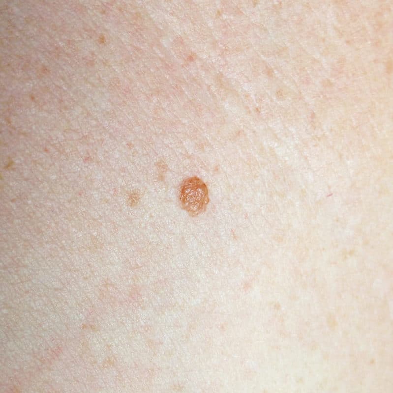 Ergebnisse Vorher/Nachher - LeaLea - Natürliche Creme zur Warzen ...