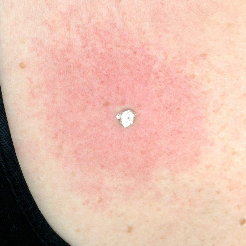 Ergebnisse Vorher/Nachher - LeaLea - Natürliche Creme zur Warzen ...