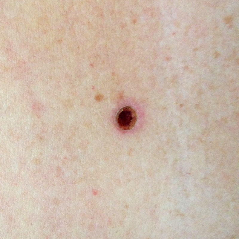 Ergebnisse Vorher/Nachher - LeaLea - Natürliche Creme zur Warzen ...