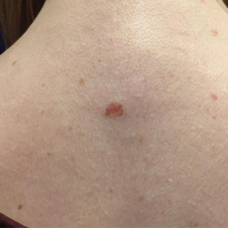 Ergebnisse Vorher/Nachher - LeaLea - Natürliche Creme zur Warzen ...