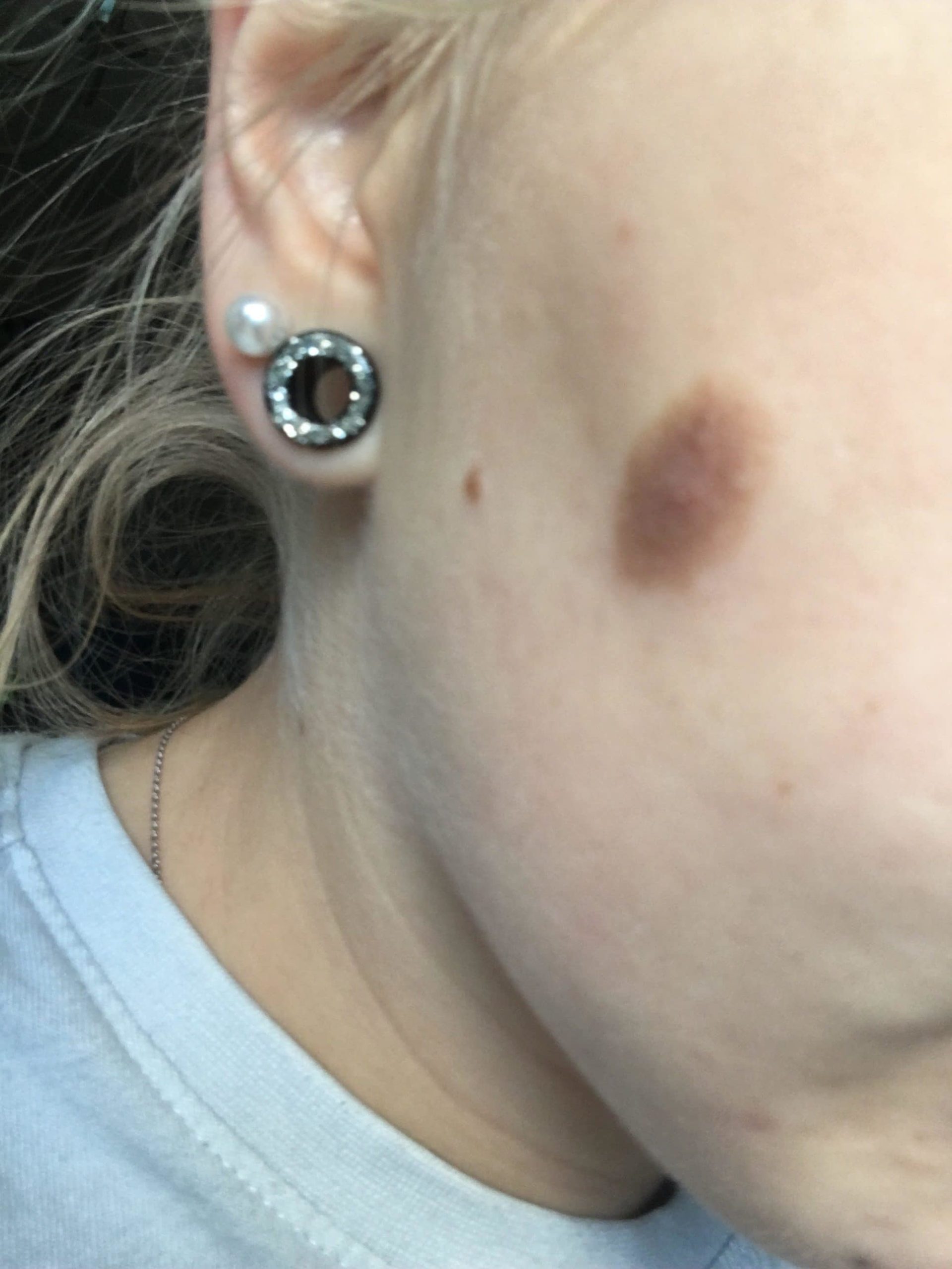 Muttermale/Leberflecken - LeaLea